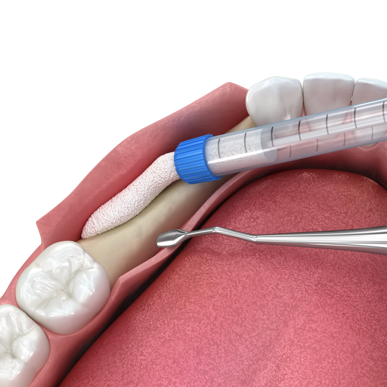 Bone Grafting Specialist | NorthShore Center for Oral & Facial Surgery