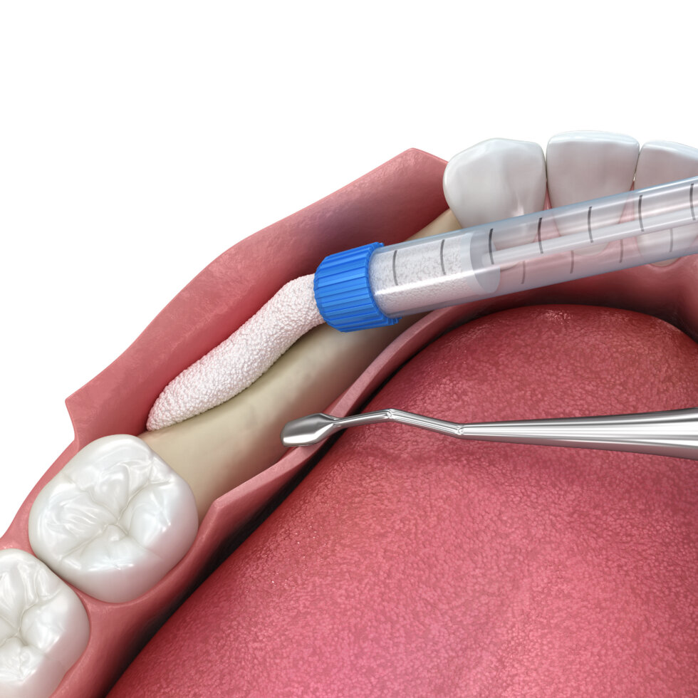Bone Grafting Specialist | NorthShore Center for Oral & Facial Surgery